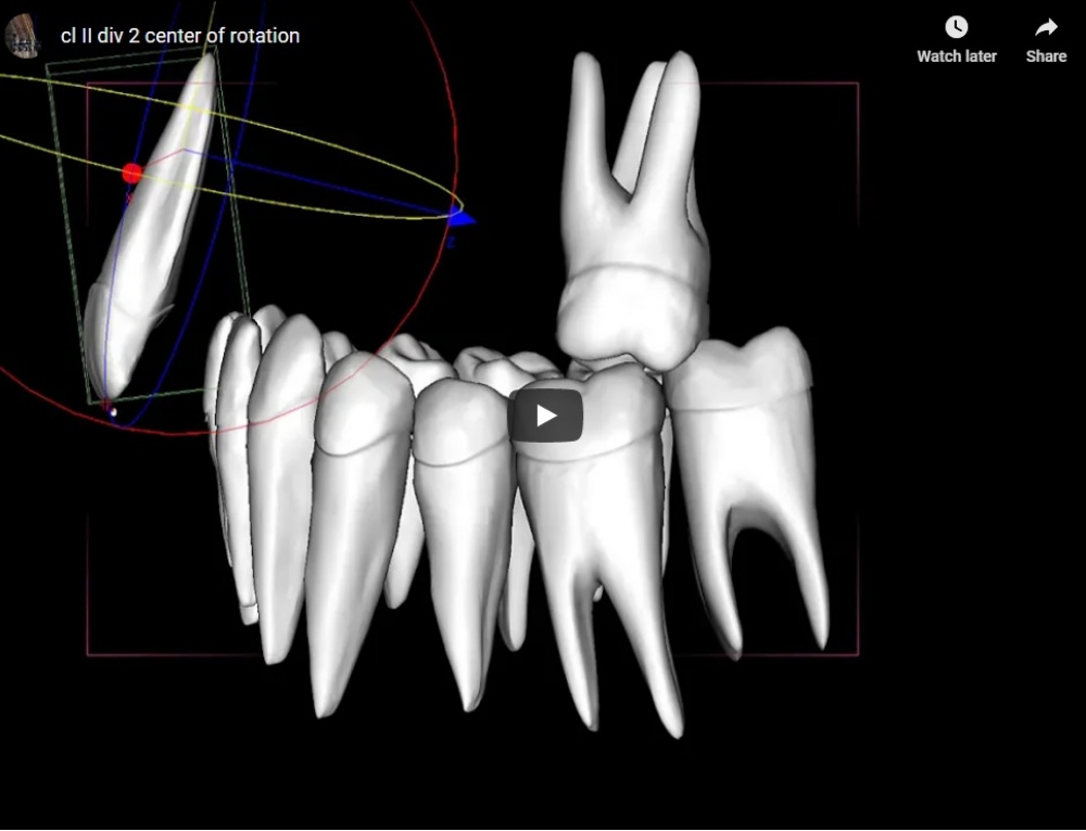 Pure Intrusion of Lower Incisors (Video) – Discover Ortho